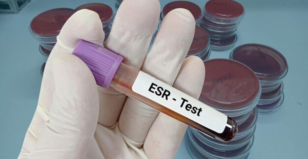 Esr Test For Women Normal Range Procedure And Common Health Insights
